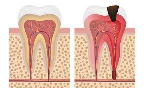De ce doare un dinte fara nerv? - CUBIC DENT